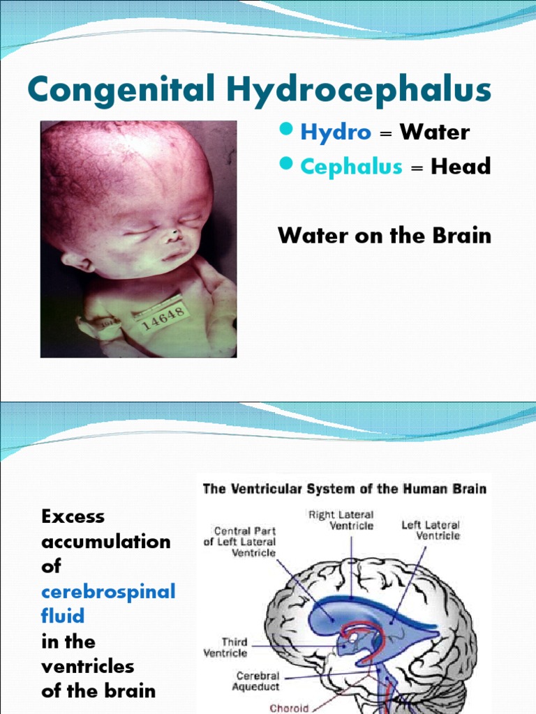 Congenital Hydrocephalus Overview | PDF