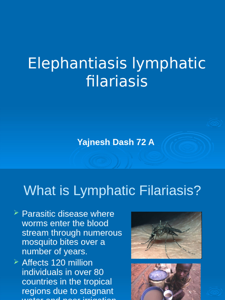 Elephantiasis Lymphatic Filariasis | PDF | Medical Specialties ...