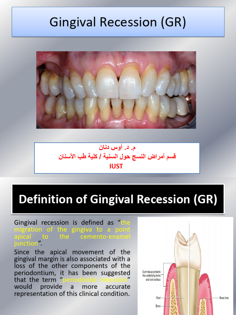Understanding Gingival Recession | PDF | Periodontology | Orthodontics