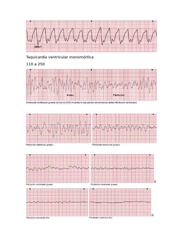 Acls Ekg | PDF