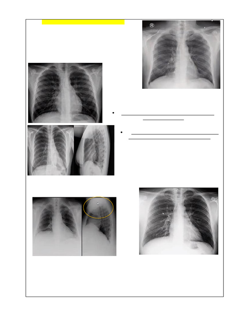RX Torax Normal y Patologico | PDF | Pulmón | Neumonía