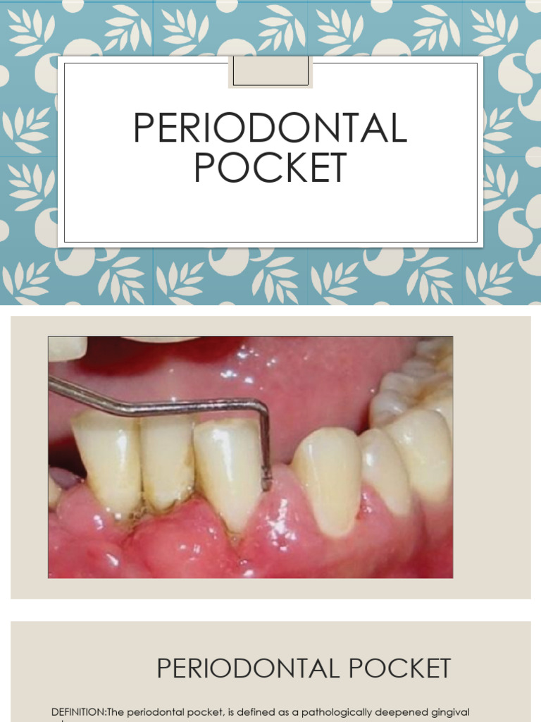 Periodontal Pocket Part I | PDF