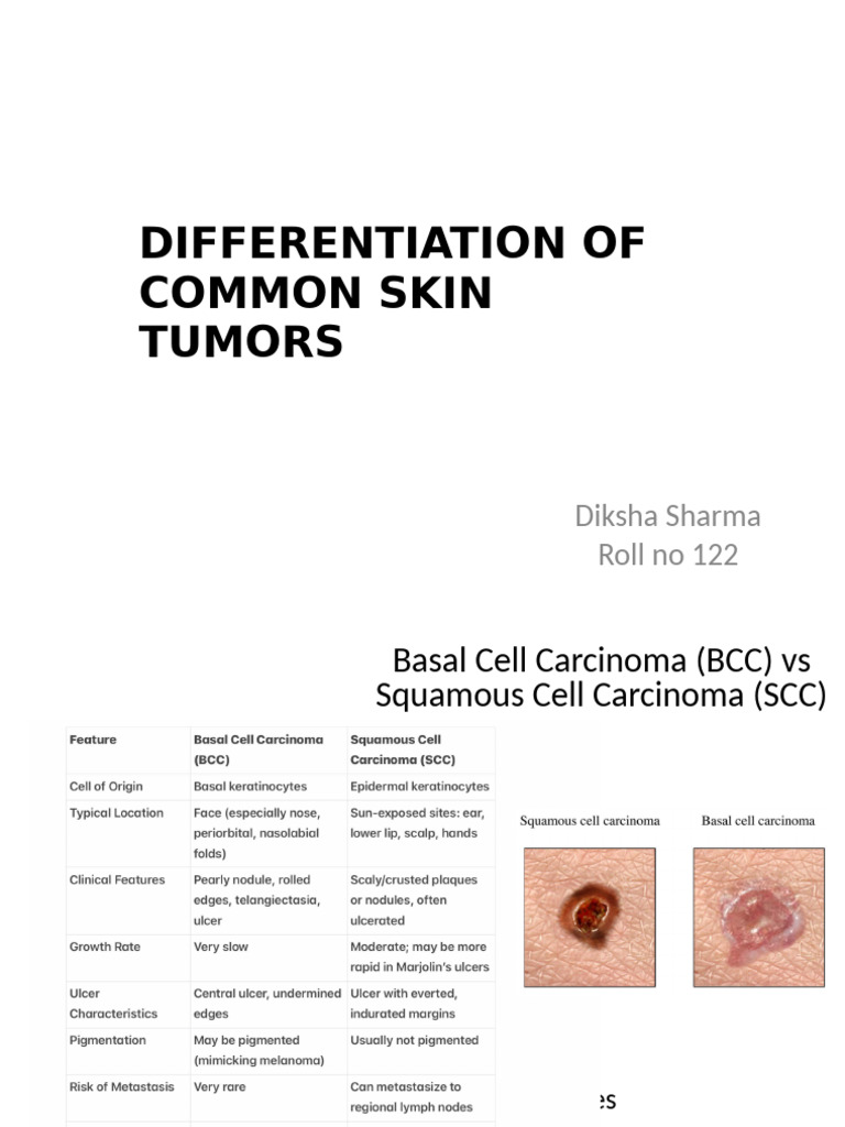 Differentiating Skin Tumors: BCC, SCC, Melanoma | PDF
