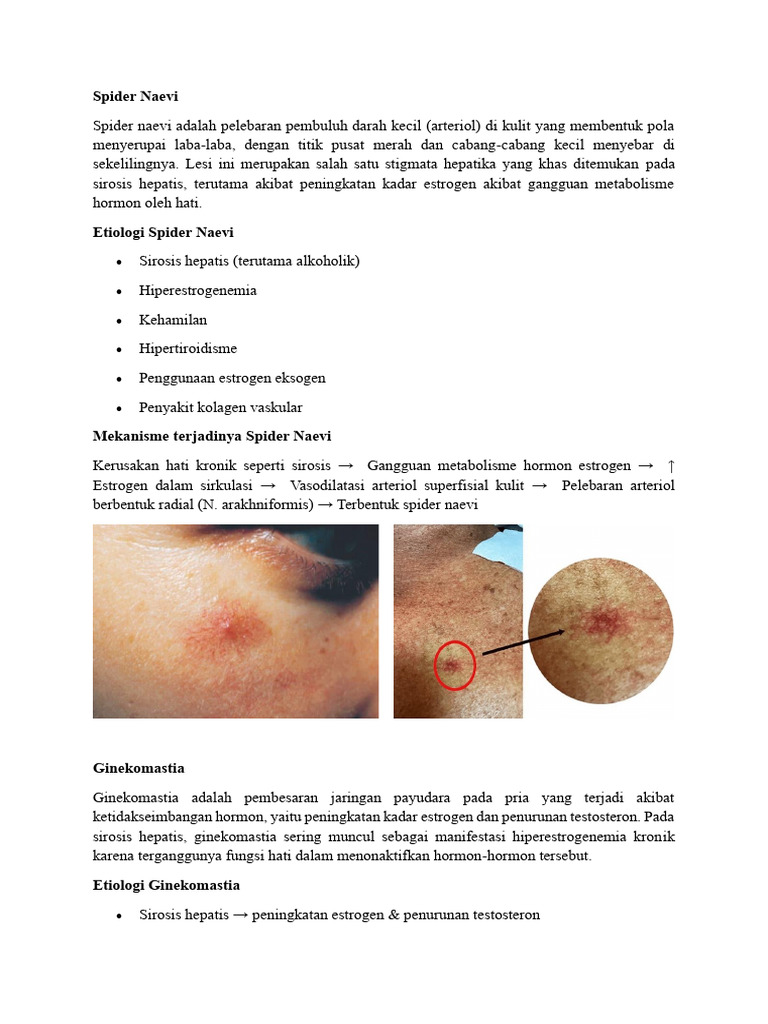 Spider Naevi, Ginekomastia, Caput Medusae | PDF