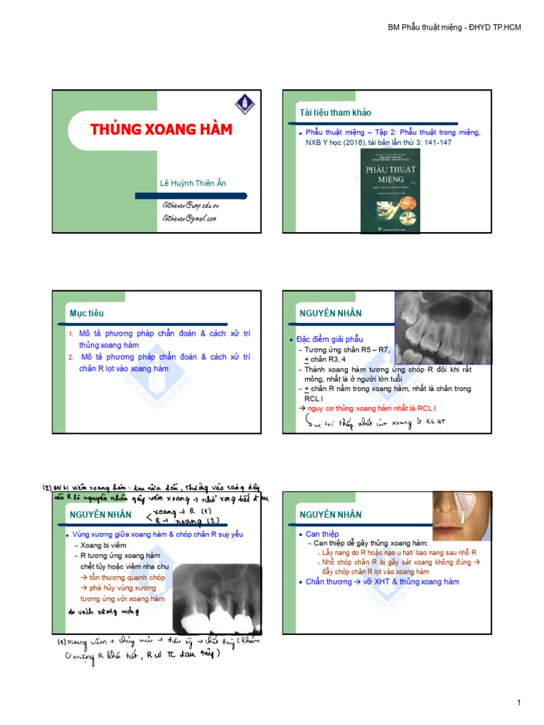 TH NG Xoang - TS. Thiên Ân | PDF
