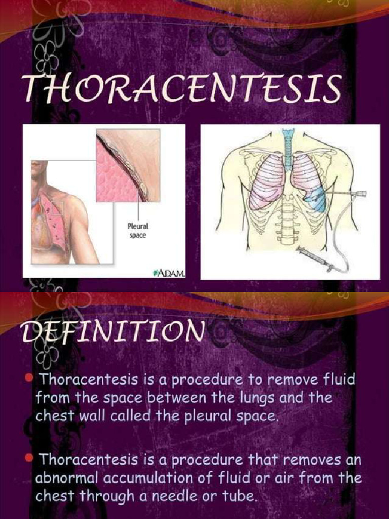 Thoracocentesis Detailed Well Structured Notes | PDF