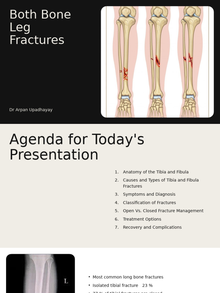 Both Bone Leg Fractures | PDF | Wound | Traumatology