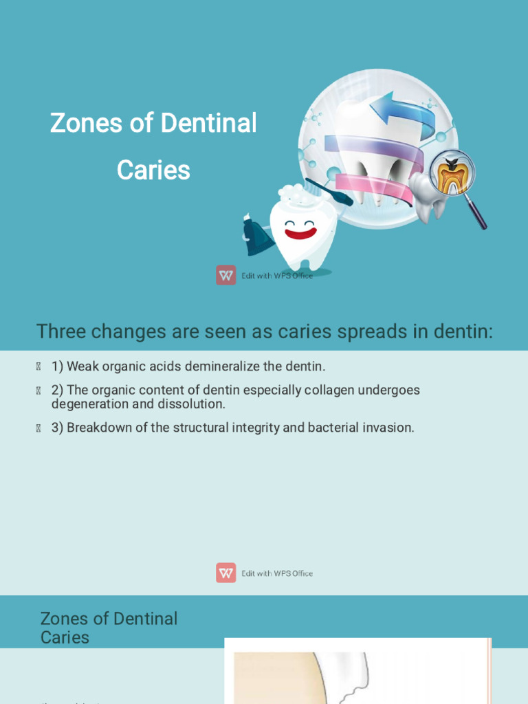 Zones of Dentinal Caries Explained | PDF | Dentin | Tooth Enamel