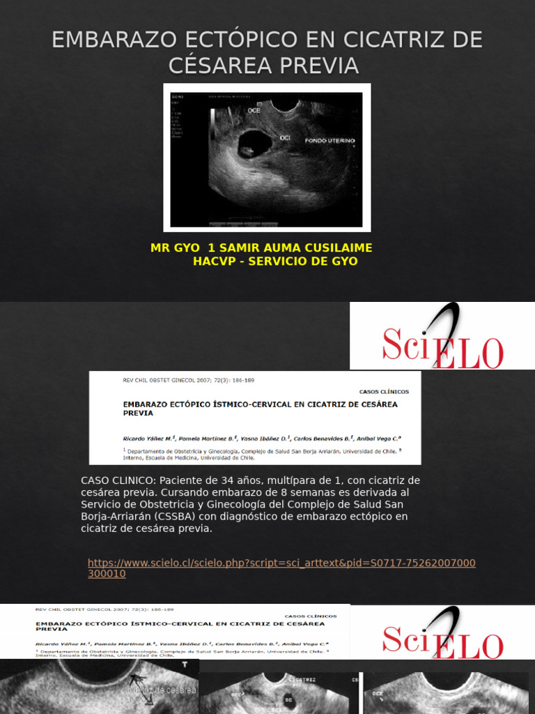 Embarazo Ectópico en Cicatriz de Césarea Previa | PDF | El embarazo ...