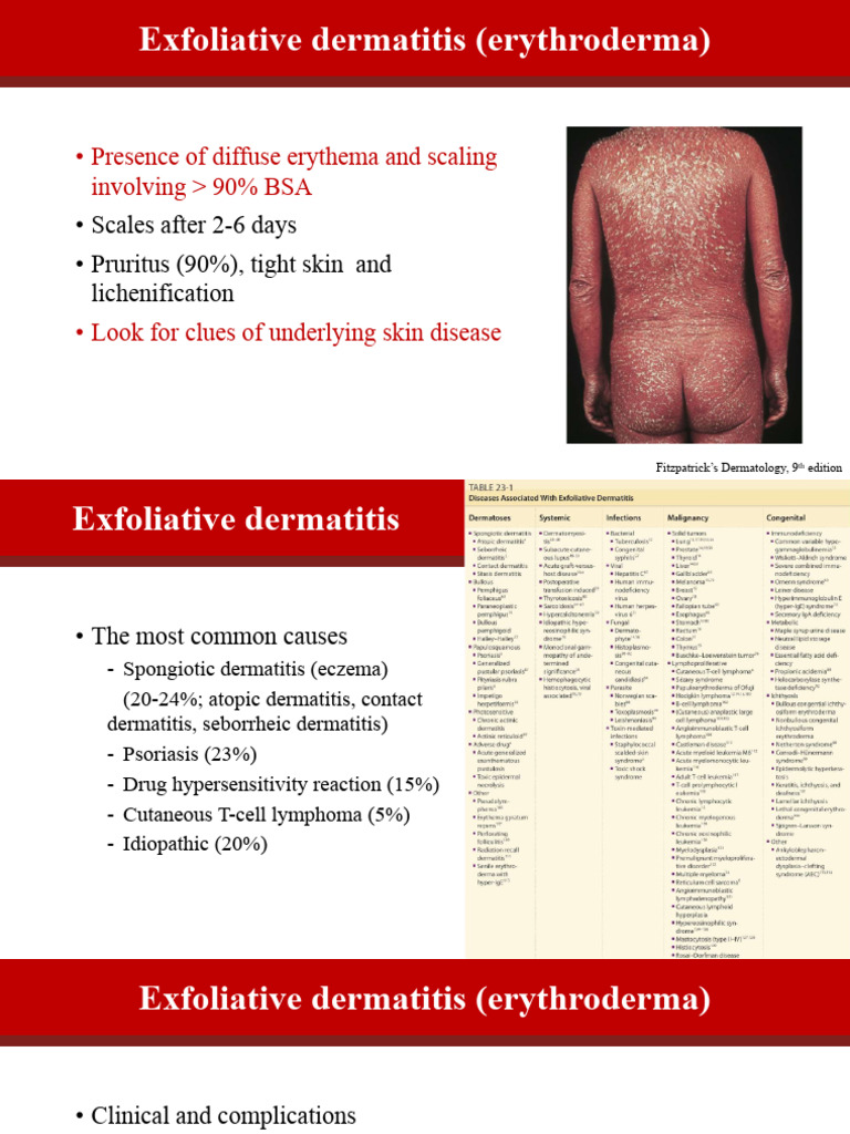 Exfoliative Dermatitis Overview & Management | PDF