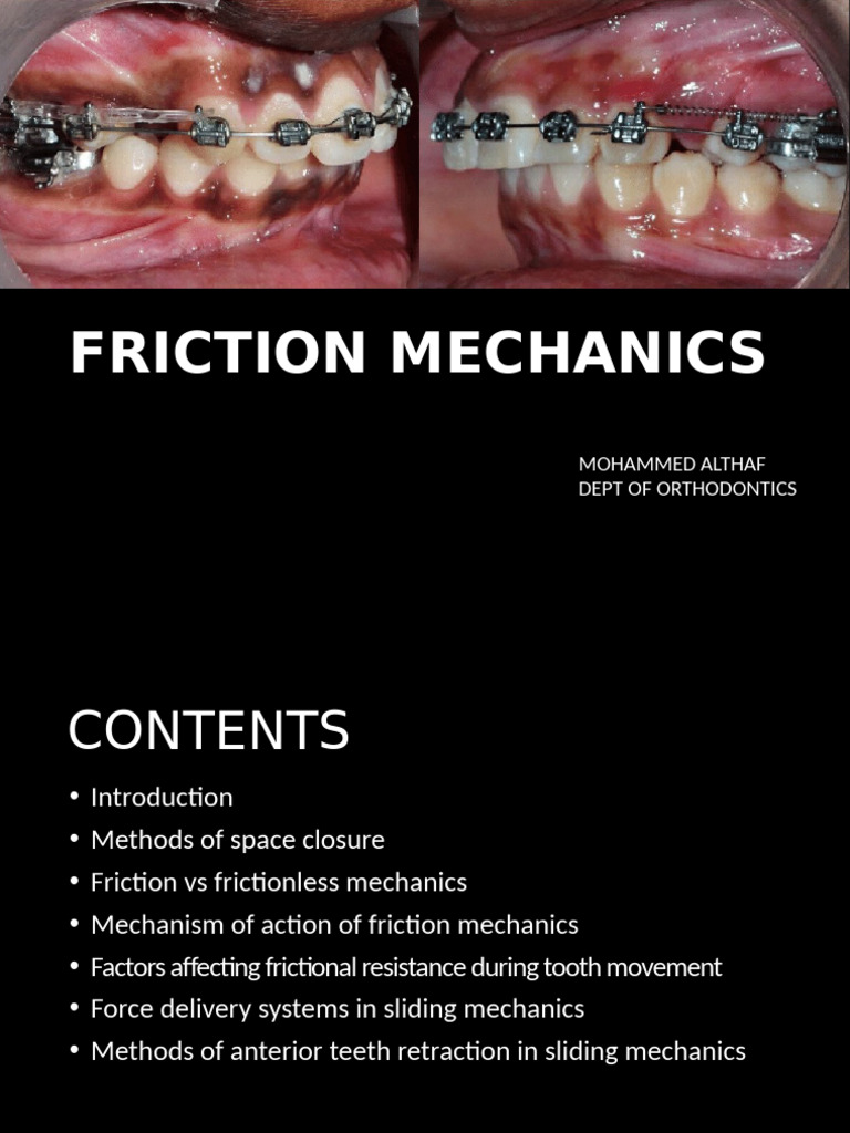 Friction Mechanics in Orthodontics | PDF | Orthodontics | Friction
