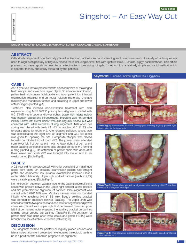 Slingshot - An Easy Way Out | PDF | Tooth | Dentistry