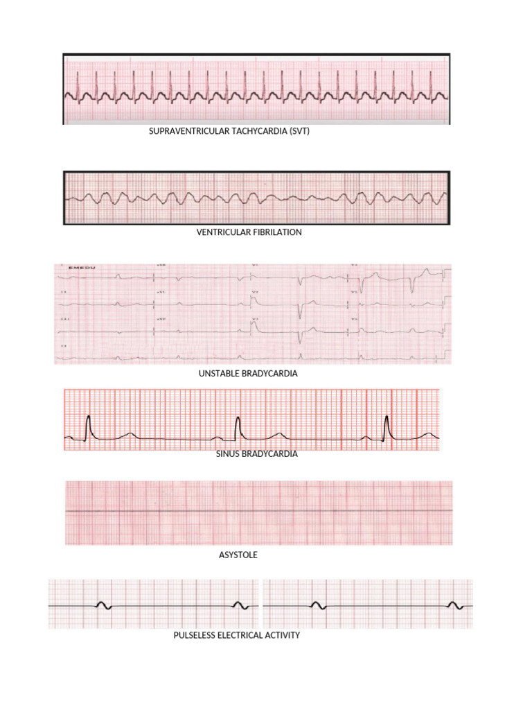 Ecg-Tracing 080432 | PDF