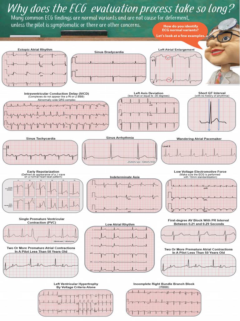 Identifying ECG Normal Variants | PDF | Electrocardiography | Medical ...