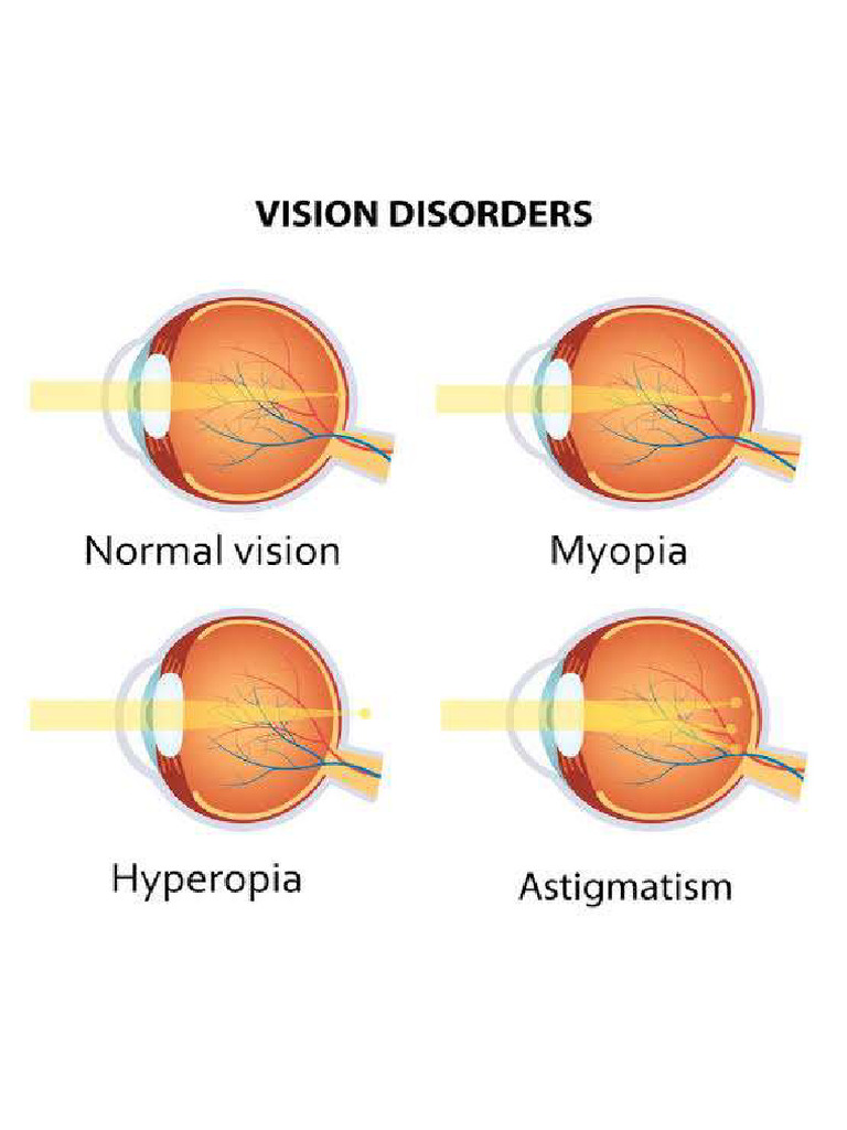 Vision Disorders | PDF