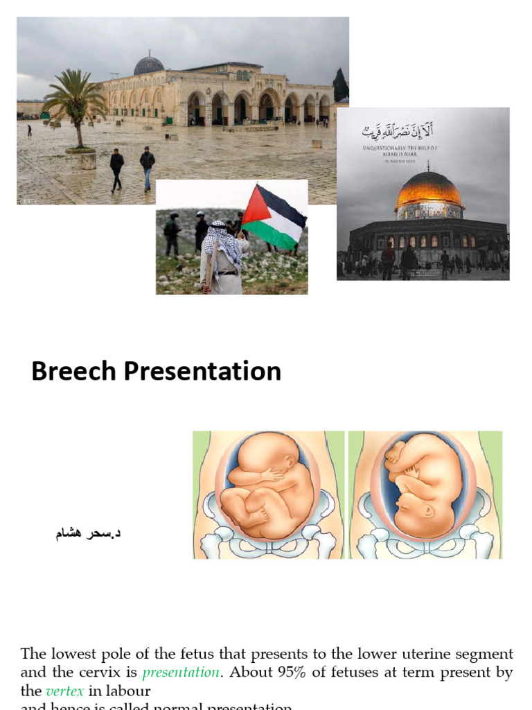 L11 - Breech Presentation | PDF | Childbirth | Caesarean Section