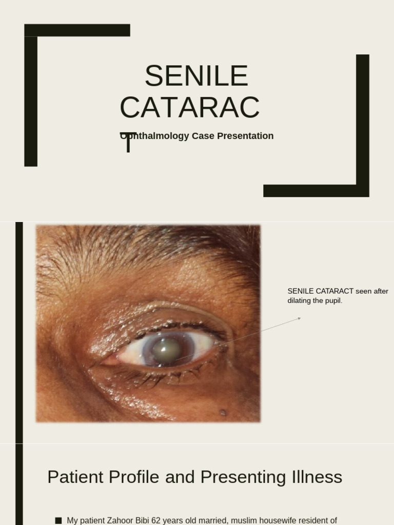 Bilateral Mature Senile Cataract Case | PDF | Cataract | Vision