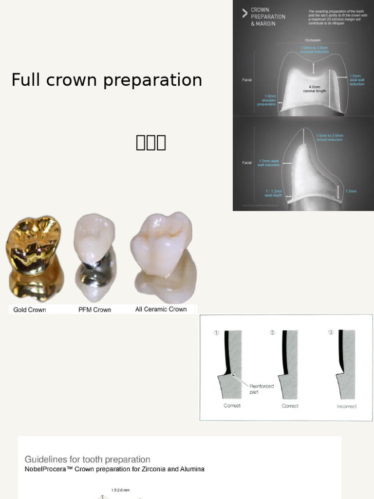 Molar Crown Preparation Steps | PDF