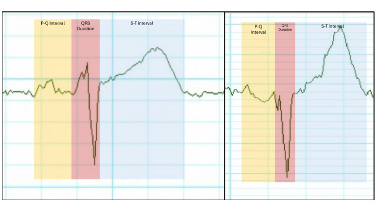 ECG Interval Measurements Guide | PDF