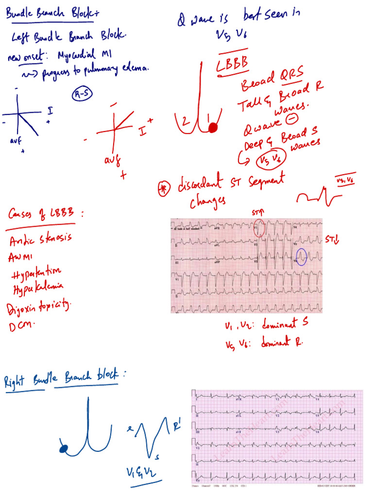 LBBB and RBBB | PDF