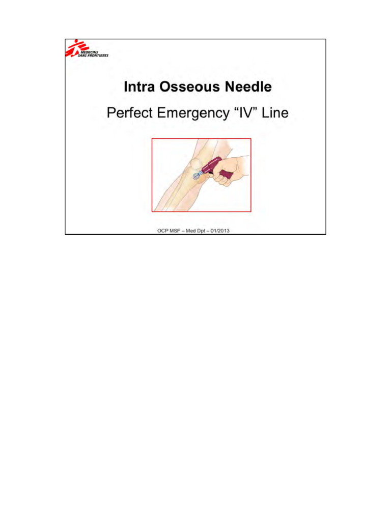 SOP IntraosseousNeedlePerfectEmergencyIVLine OCP 2020 en | PDF ...