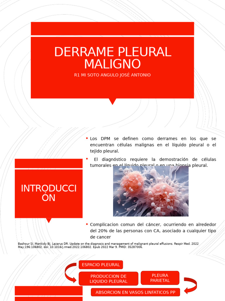 Diagnóstico y manejo del derrame pleural maligno | PDF | Cáncer ...