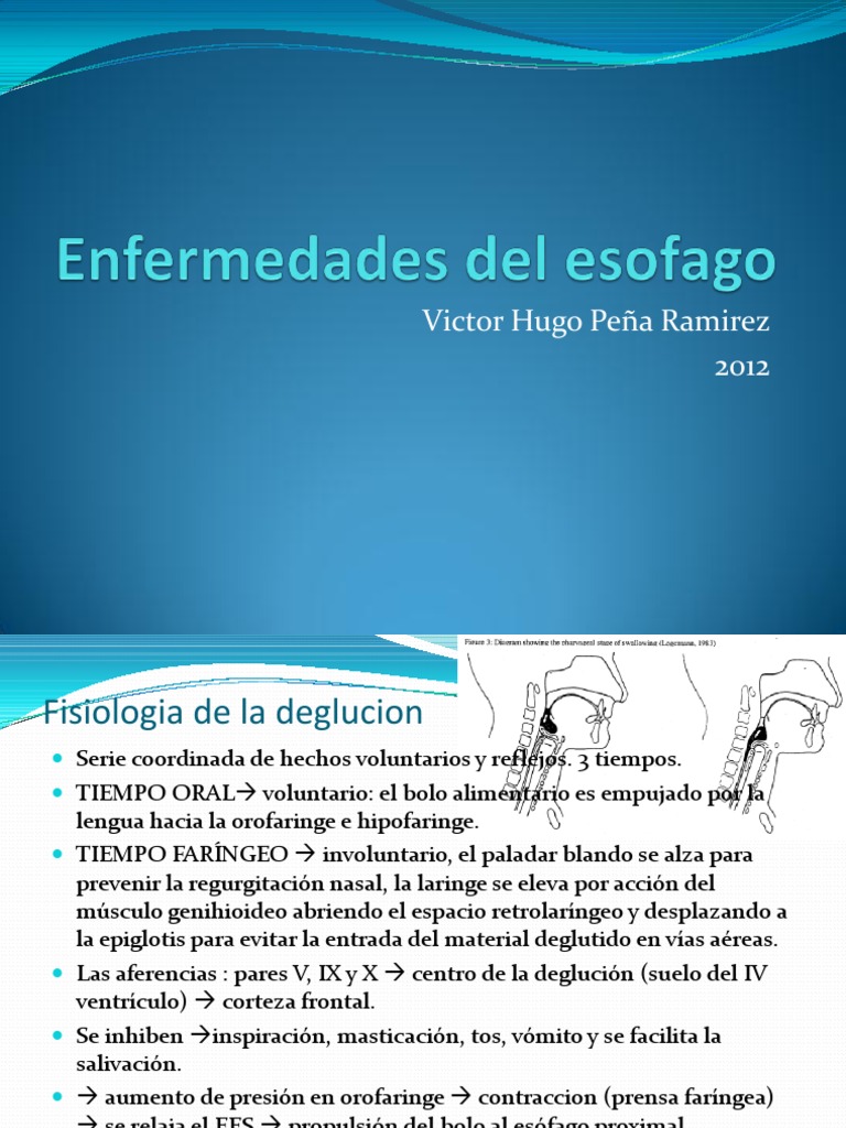 Enfermedades Del Esofago | Enfermedad del reflujo gastroesofágico ...