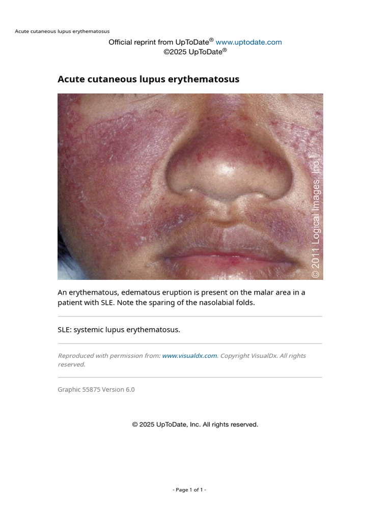 Acute Cutaneous Lupus Erythematosus | PDF