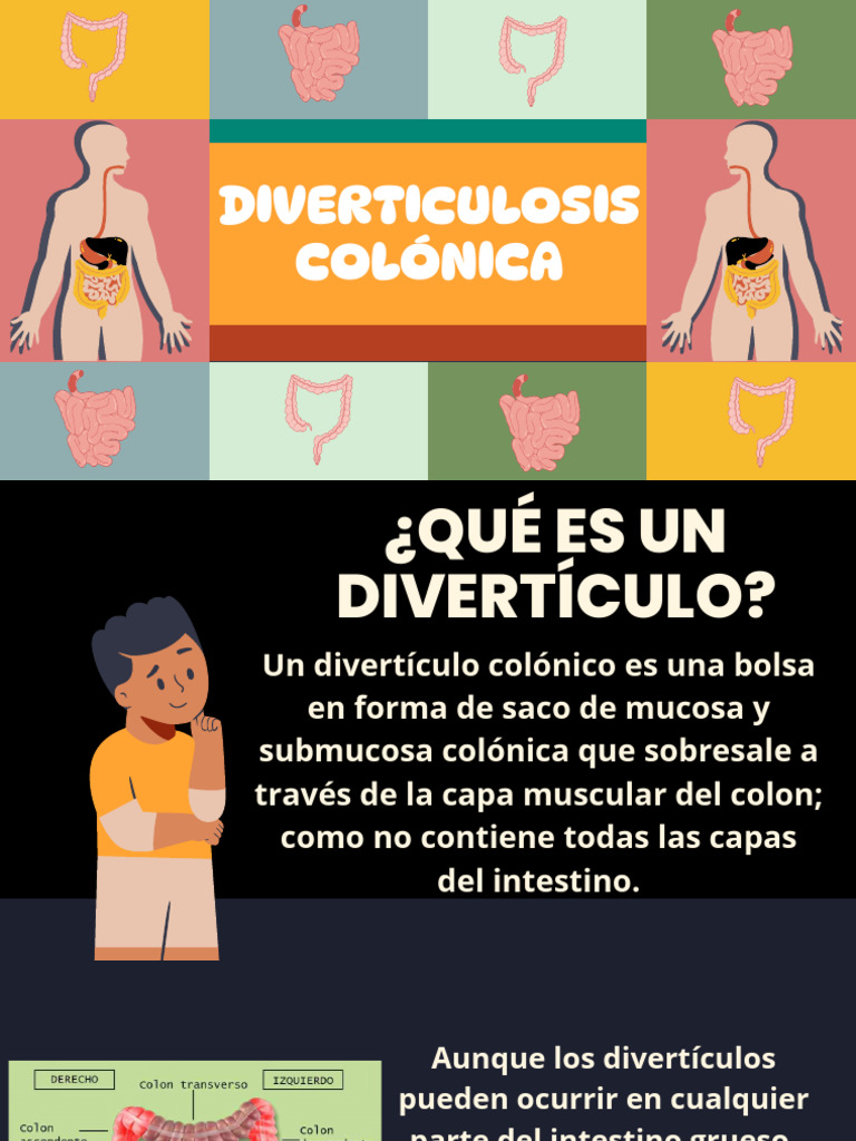 Diverticulosis colónica: causas y síntomas | PDF | Gastroenterología ...