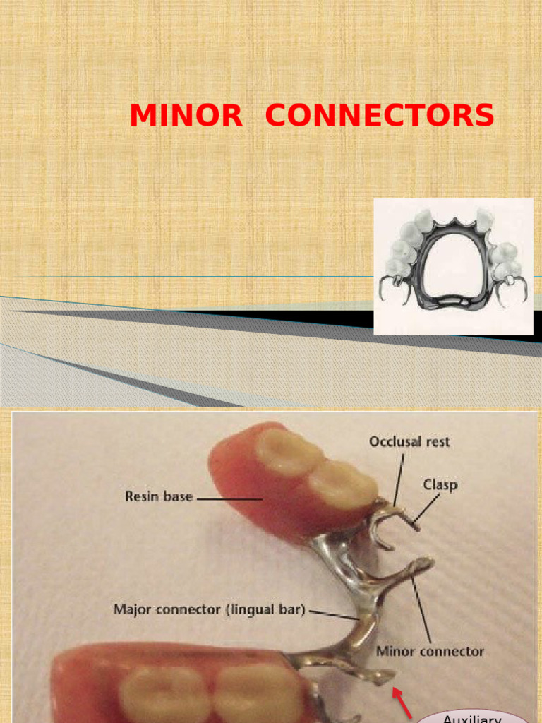 Minor Connectors , Removal Partial denture | PDF | Dental Anatomy ...