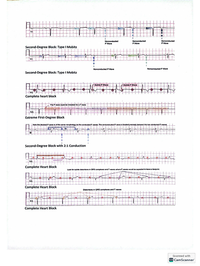 AV Conduction Block (ត) | PDF