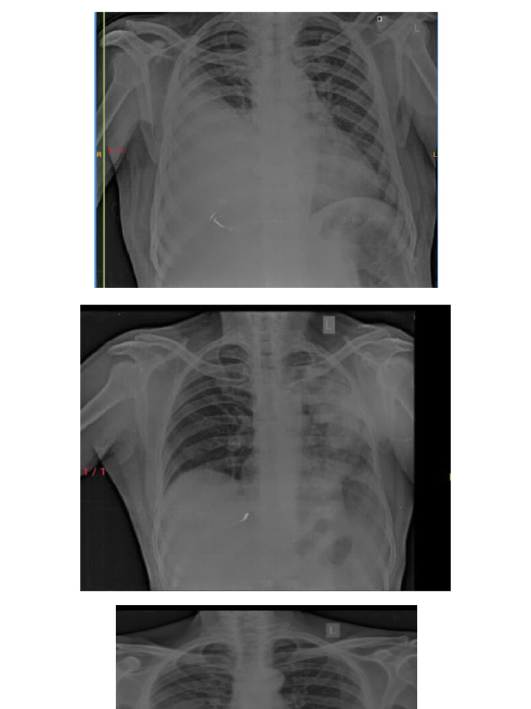 Chest X Rays | PDF
