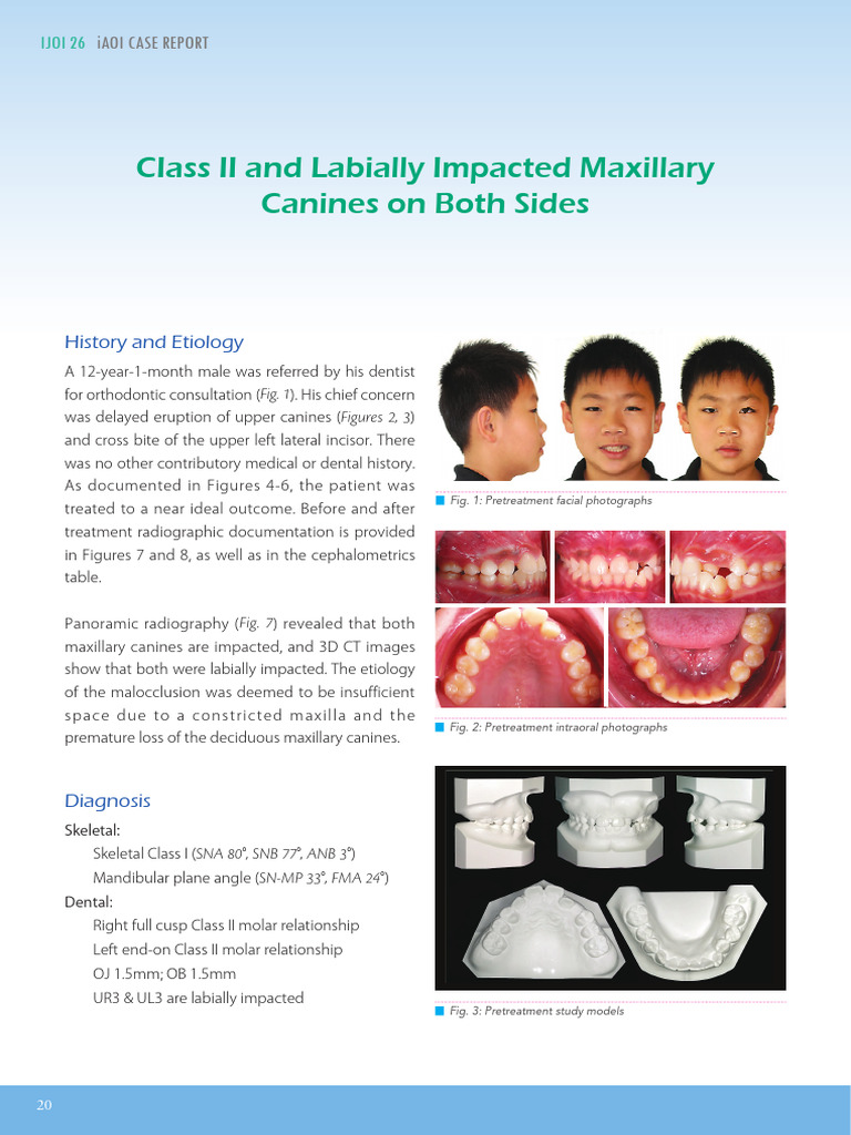 Class II and Labially Impacted Maxillary Canines On Both Sides | PDF ...