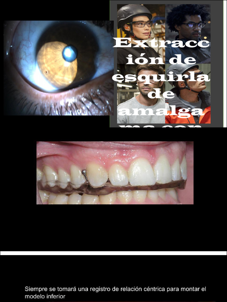 Férula Oclusal Pico de Pato: Uso y Ajustes | PDF