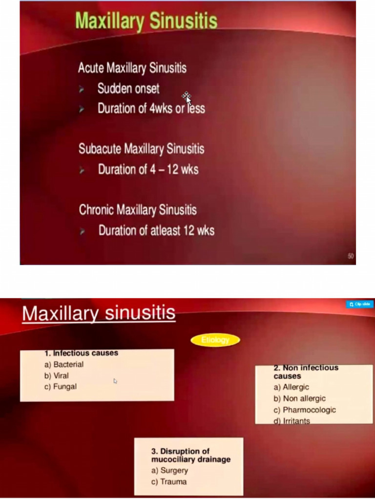 Maxillary Sinusitis Ent | PDF