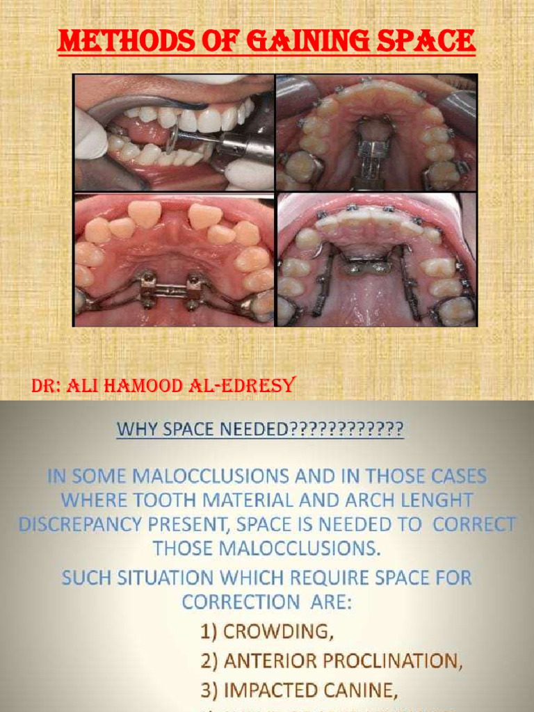 2-Methods of Gaining Space | PDF
