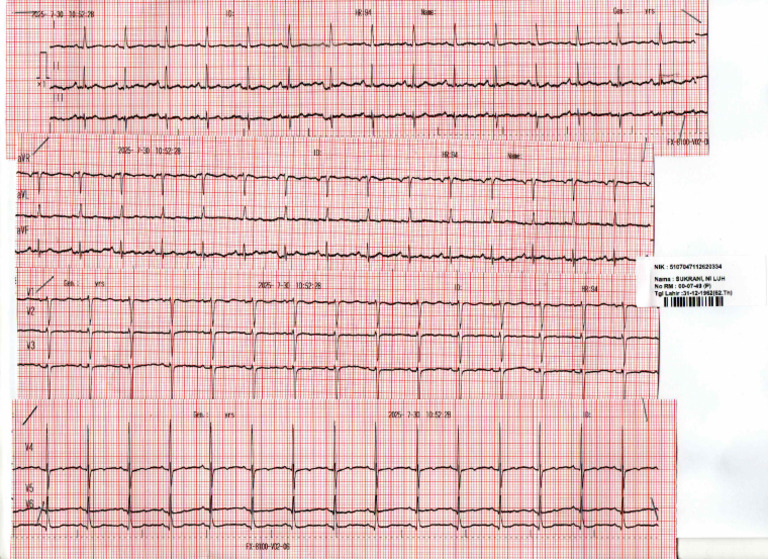 Ekg Sukrani | PDF