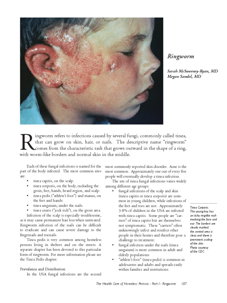 Ringworm | PDF | Epidemiology | Veterinary Medicine