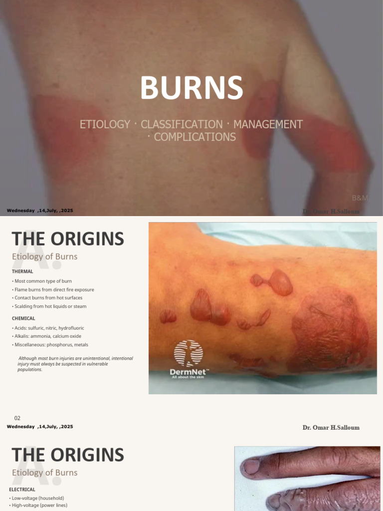 Etiology of Burn Injuries | PDF | Burn | Necrosis