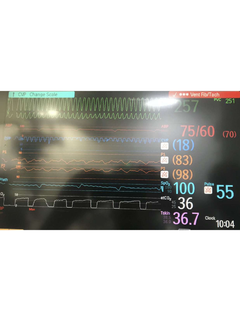 VT On VA ECMO Monitor | PDF