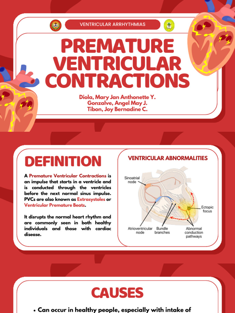 Understanding Premature Ventricular Contractions | PDF ...