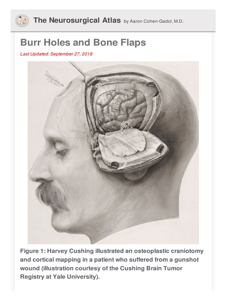 Burr Hole Surgery Techniques and Risks | PDF | Skull | Human Head And Neck