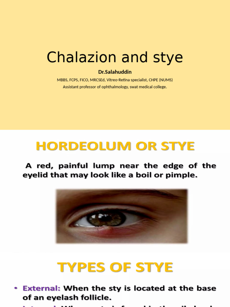 Chalazion and Stye | PDF