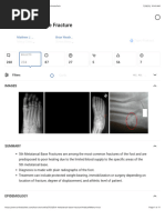 5th Metatarsal Base Fracture - Foot & Ankle - Orthobullets | PDF | Foot ...