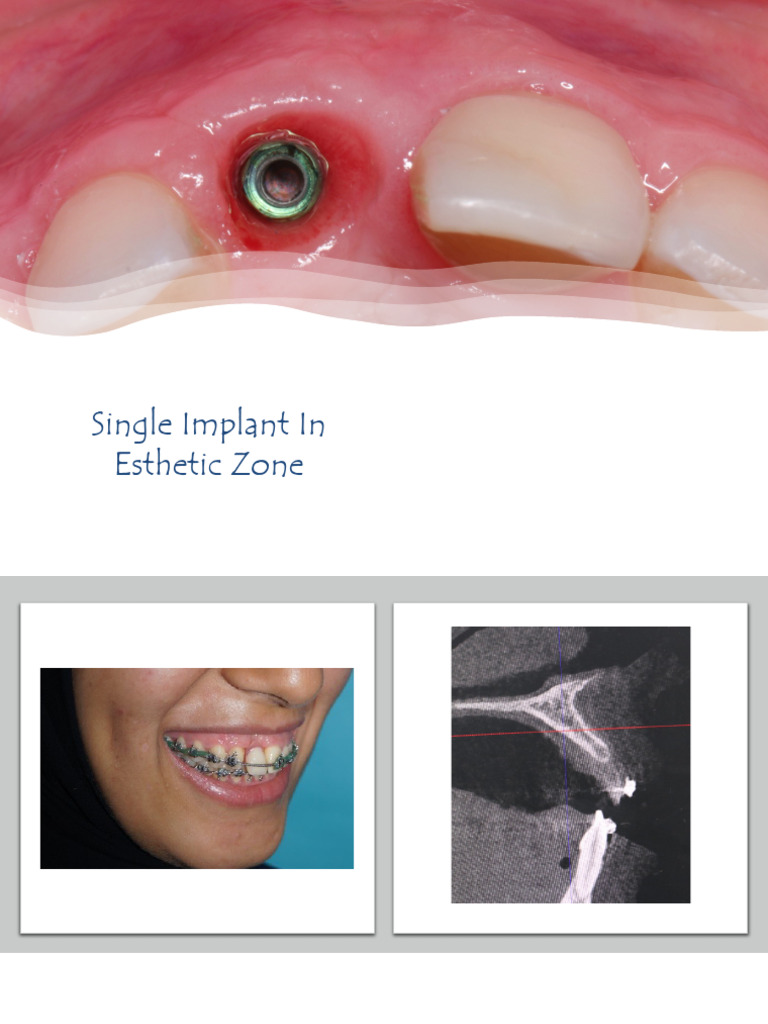 Single Implant Esthetic Zone Guide | PDF