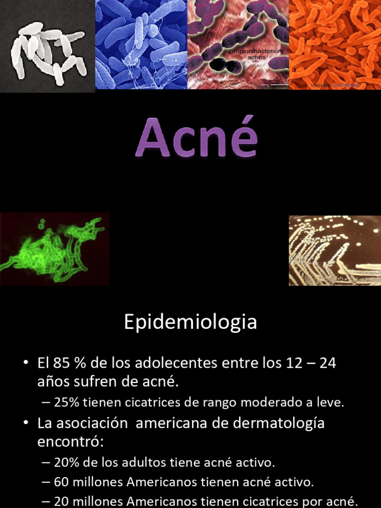 Epidemiología y Tratamiento del Acné | PDF | Dermatología | Piel