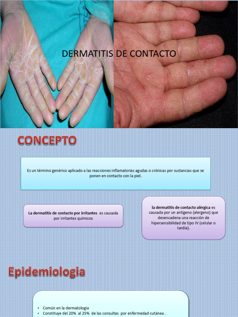 Dermatitis de Contacto (Buscar) | PDF | Alergia | Inflamación