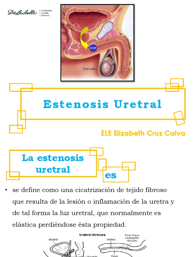 Estenosis Uretral | Sistema urinario | Urología