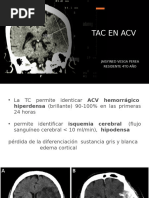 Escala ASPECTS en infarto cerebral | PDF