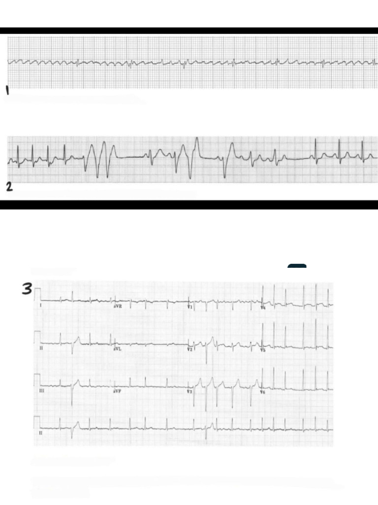 Ecg Strips | PDF